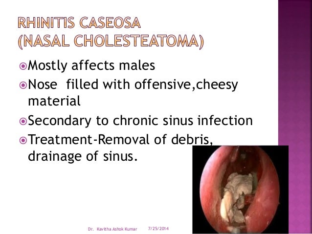 Diseases of nose by Dr. Kavitha Ashok Kumar MSU MAlaysia
