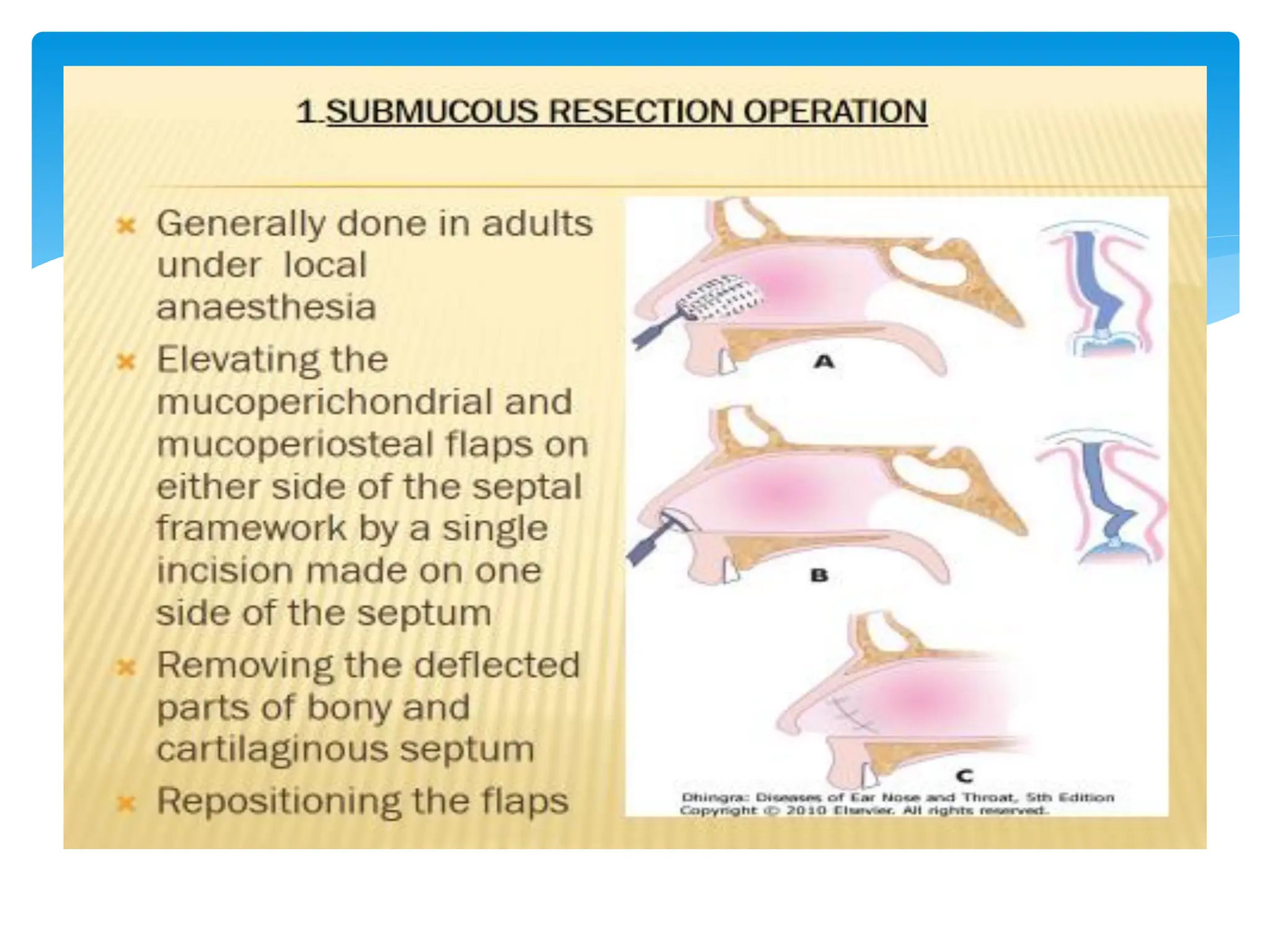 Diseases of nose and paranasal sinuses.pdf