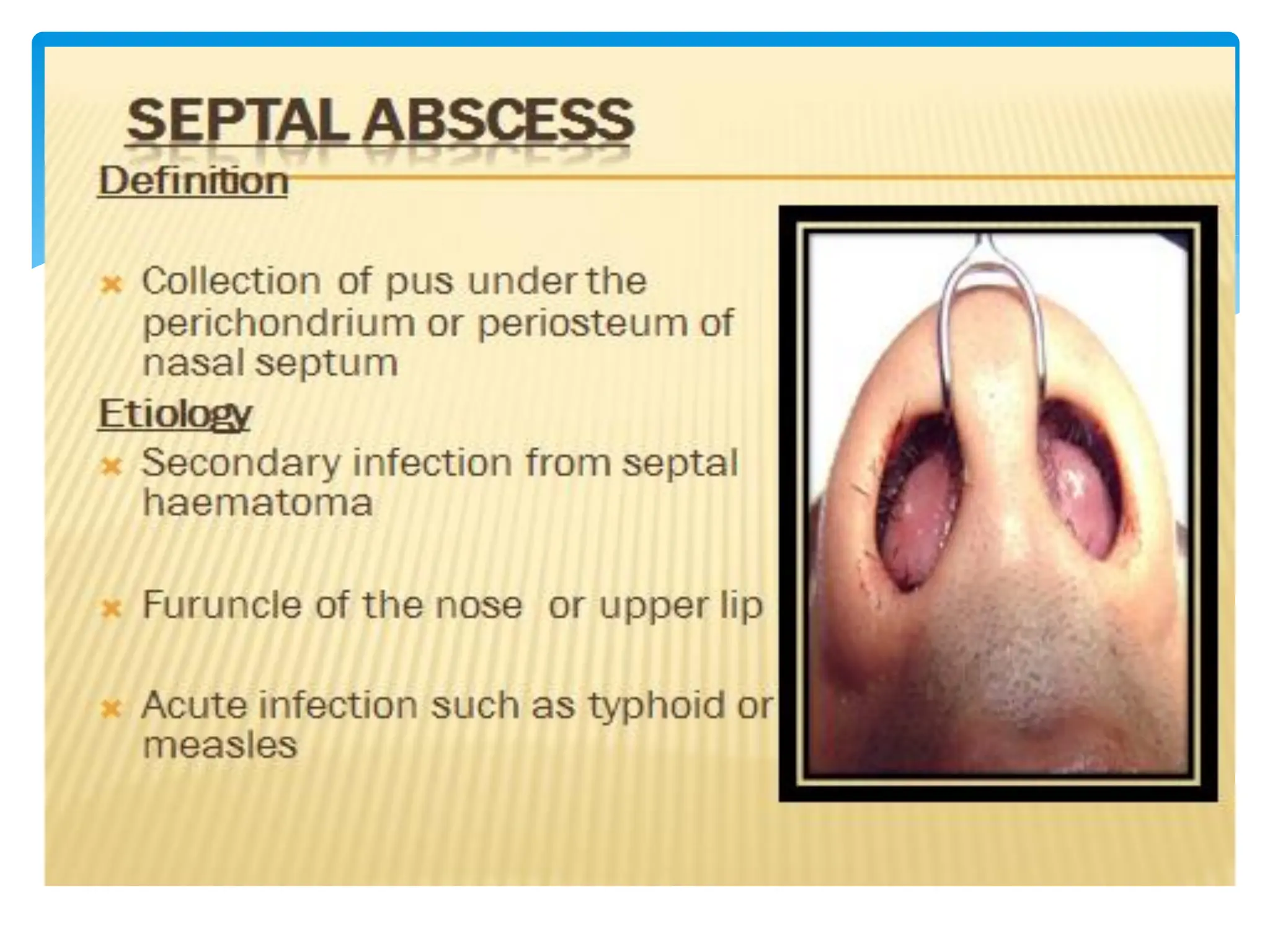 Diseases of nose and paranasal sinuses.pdf