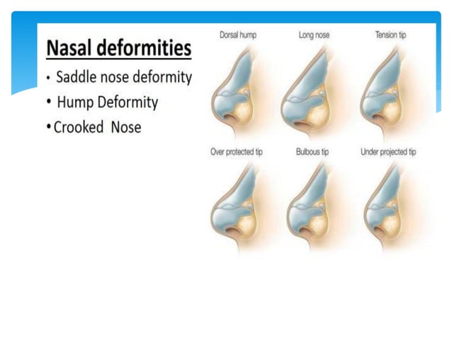 Diseases of nose and paranasal sinuses.pdf