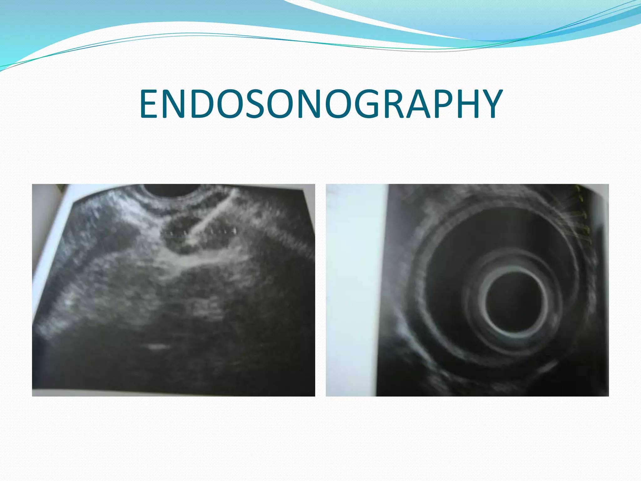 Diseases of oesophagus | PPTX