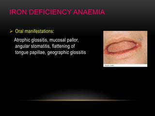 Diseases of oral cavity | PPTX