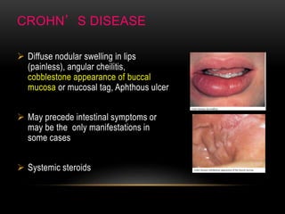 Cobblestoning Of The Posterior Pharynx