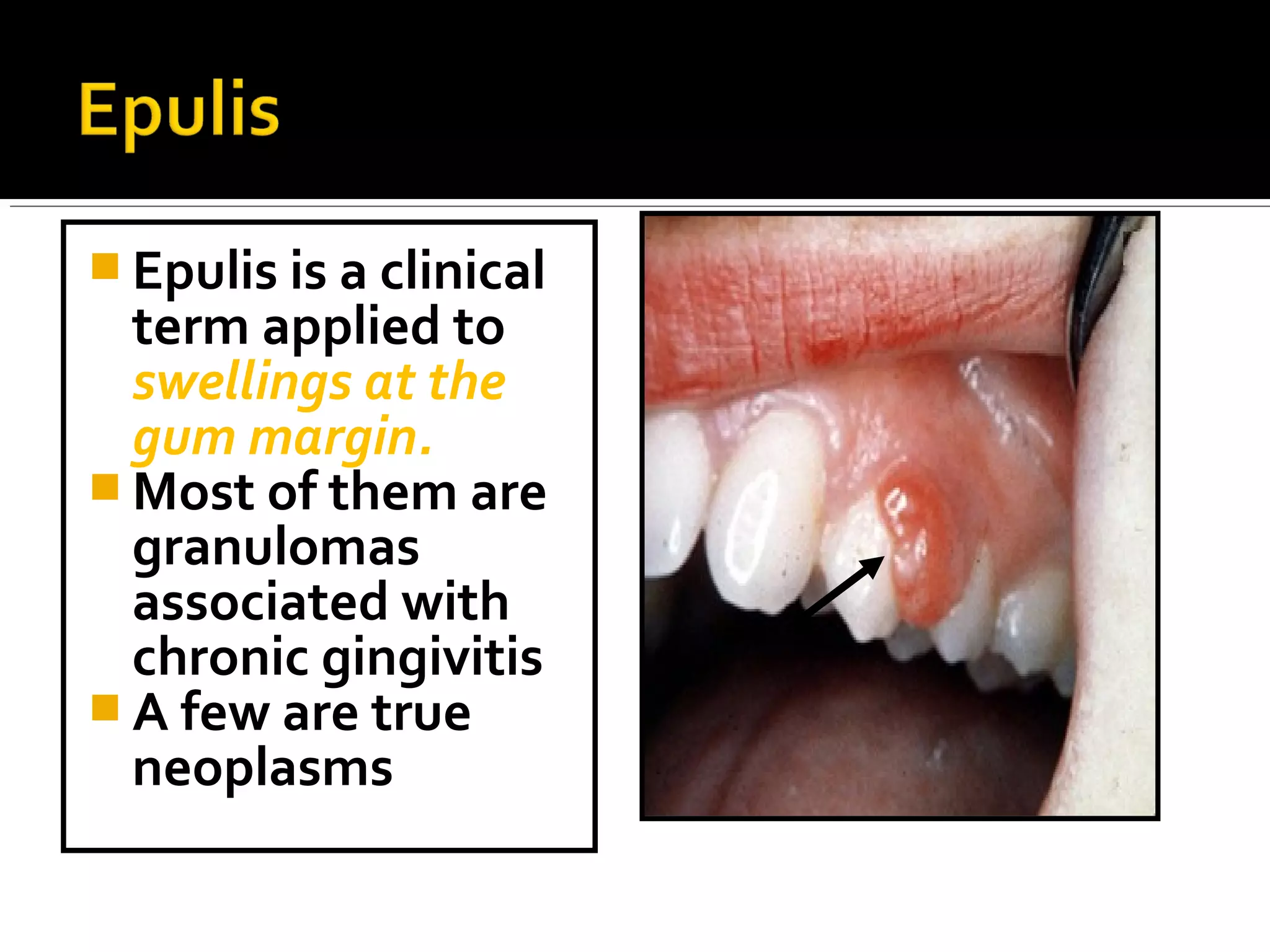 Diseases of oral cavity and ludwig’s angina ug,18.07.16 dr.davis thomas ...