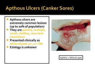Diseases of oral cavity and ludwig’s angina ug,18.07.16 dr.davis thomas ...