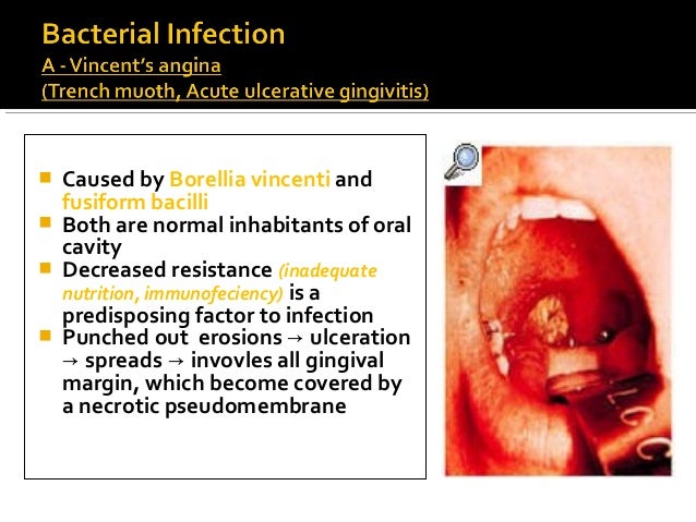 Vincent Angina Symptoms