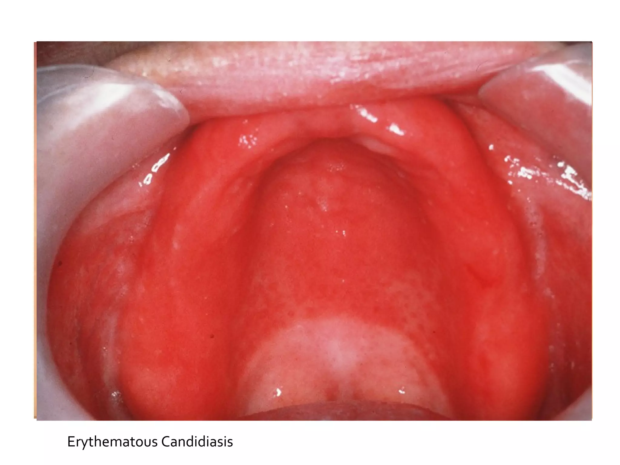 Diseases of oral cavity and ludwig’s angina ug,18.07.16 dr.davis thomas ...