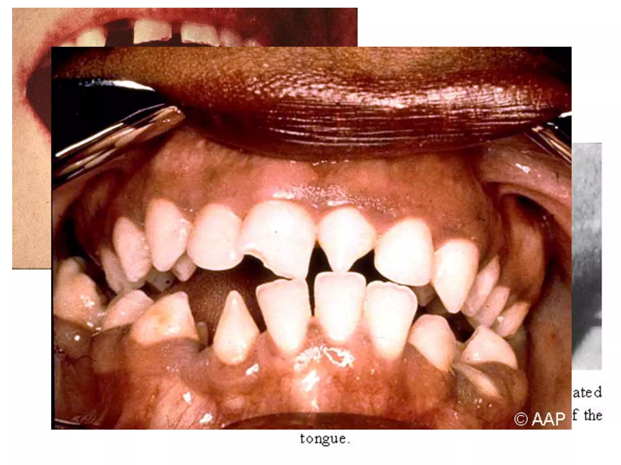 Diseases of oral cavity and ludwig’s angina ug,18.07.16 dr.davis thomas ...