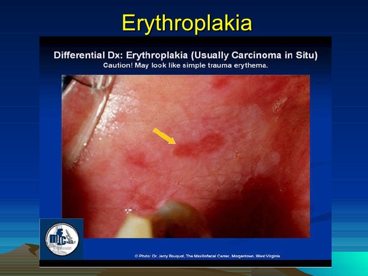 Diseases of oral cav, nasoph and oroph