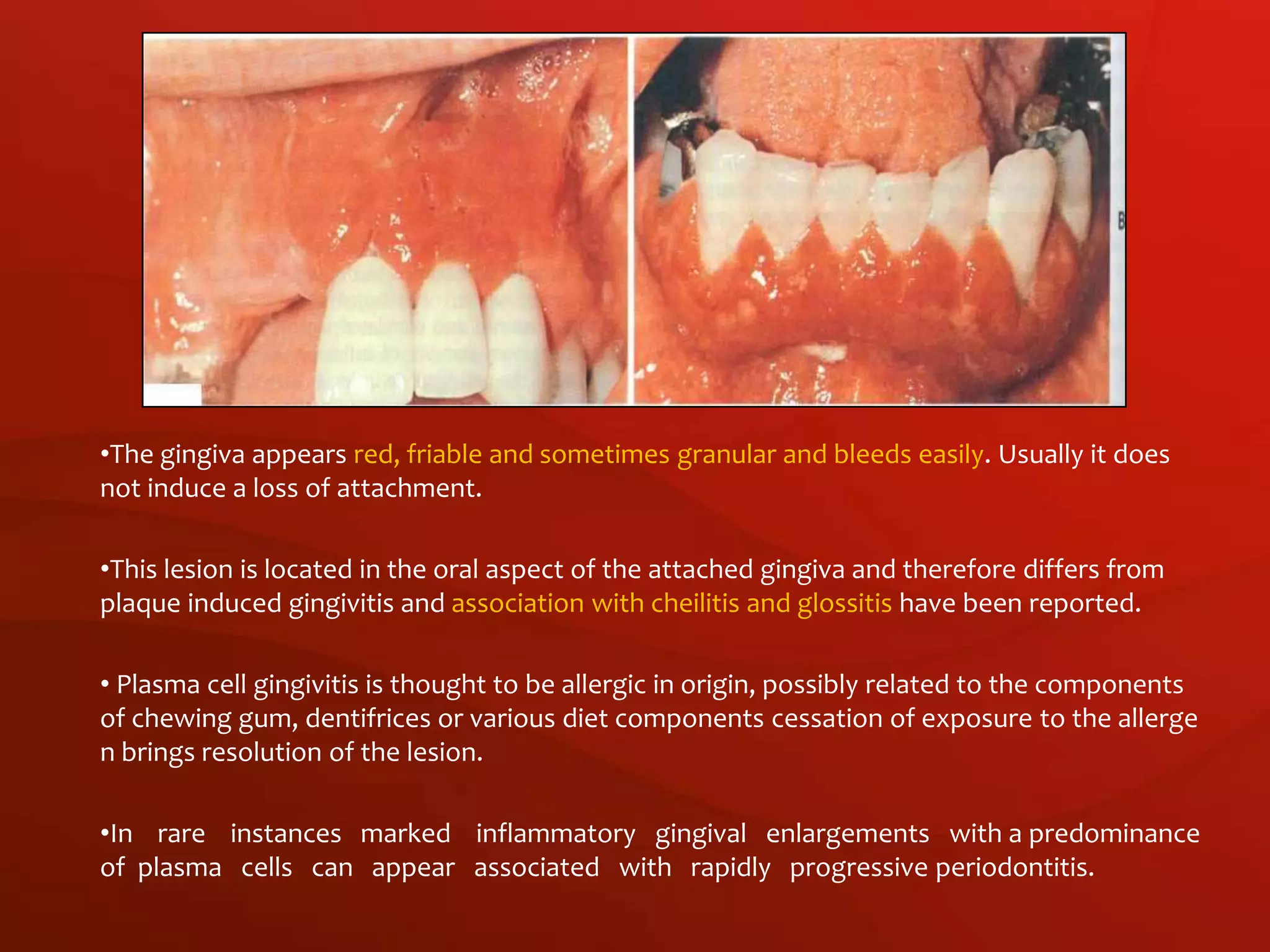Diseases of periodontium | PPTX