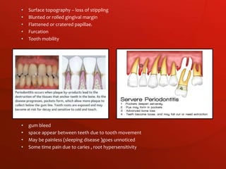 Diseases of periodontium | PPTX
