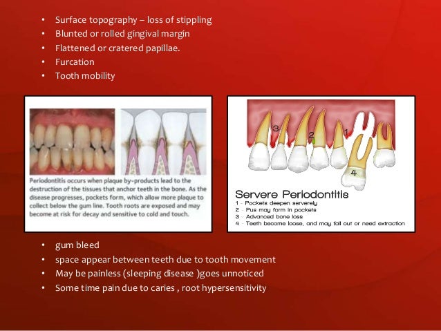 Diseases of periodontium