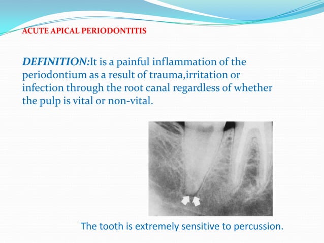 Diseases of periradicular tissues by dr ramesh bharti | PPTX