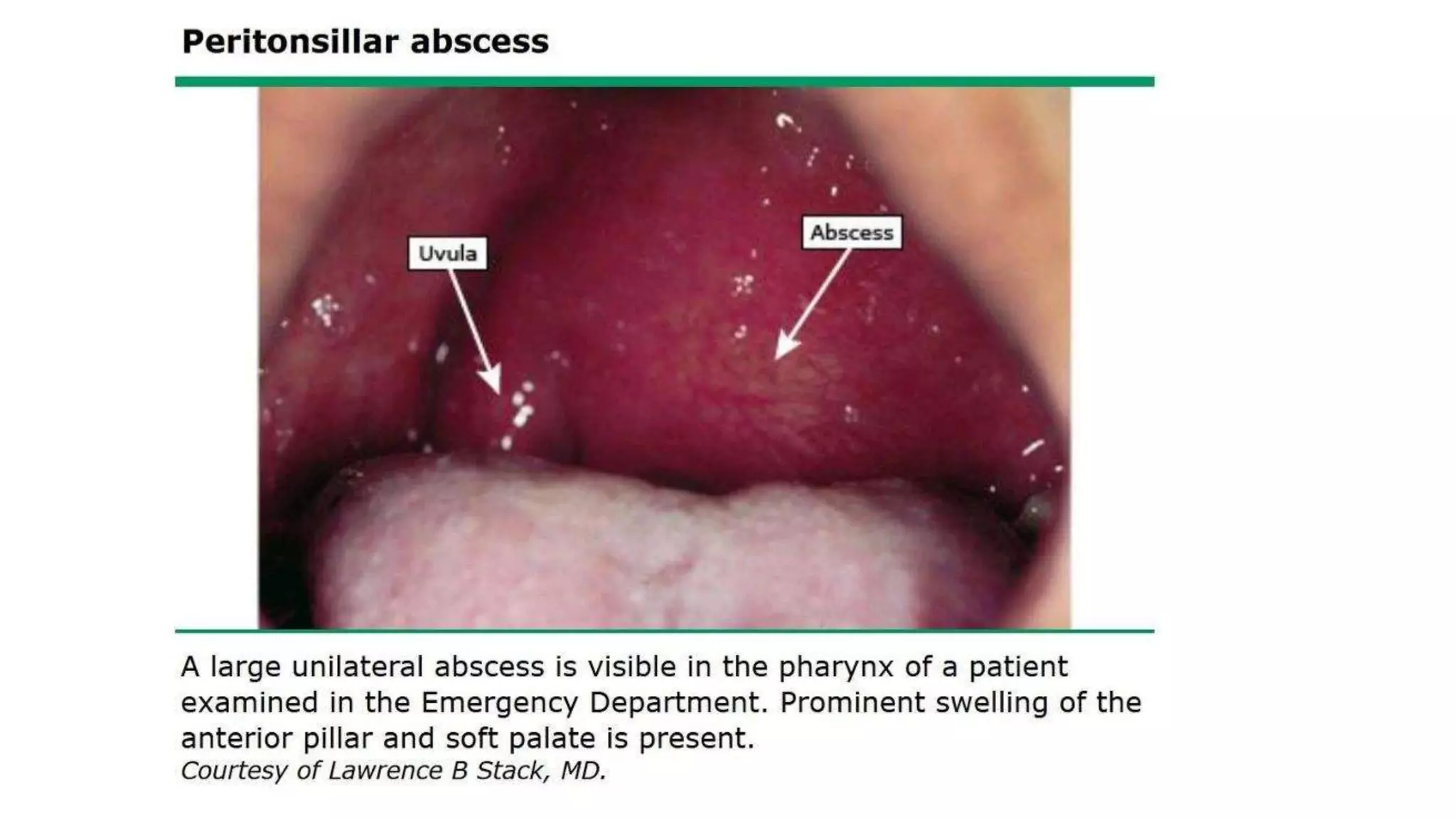 diseases of pharynx.pptx