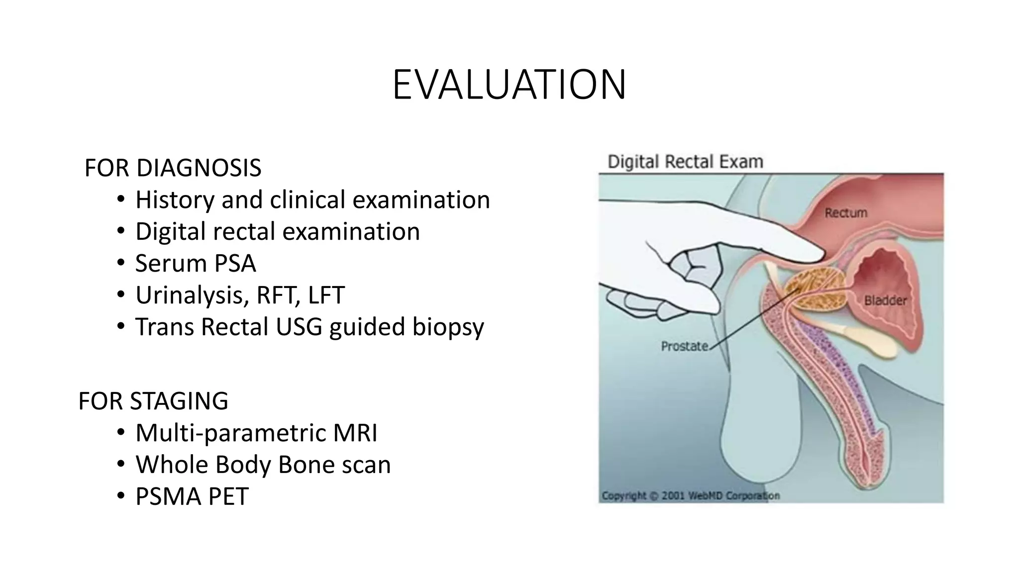 DISEASES OF PROSTATE.pptx