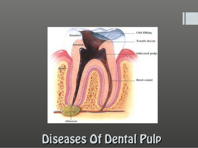 Diseases of pulp