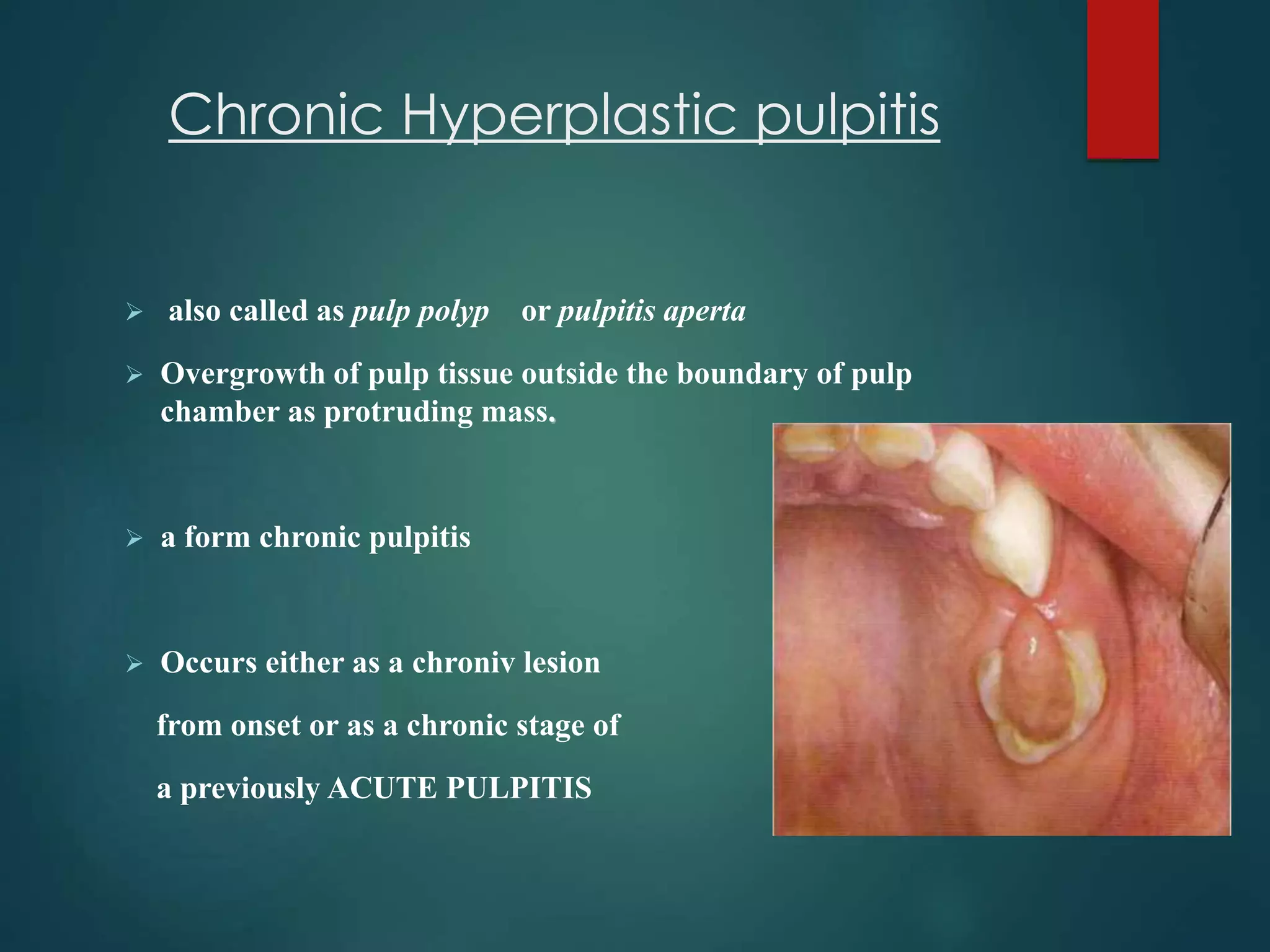Diseases of pulp | PPTX