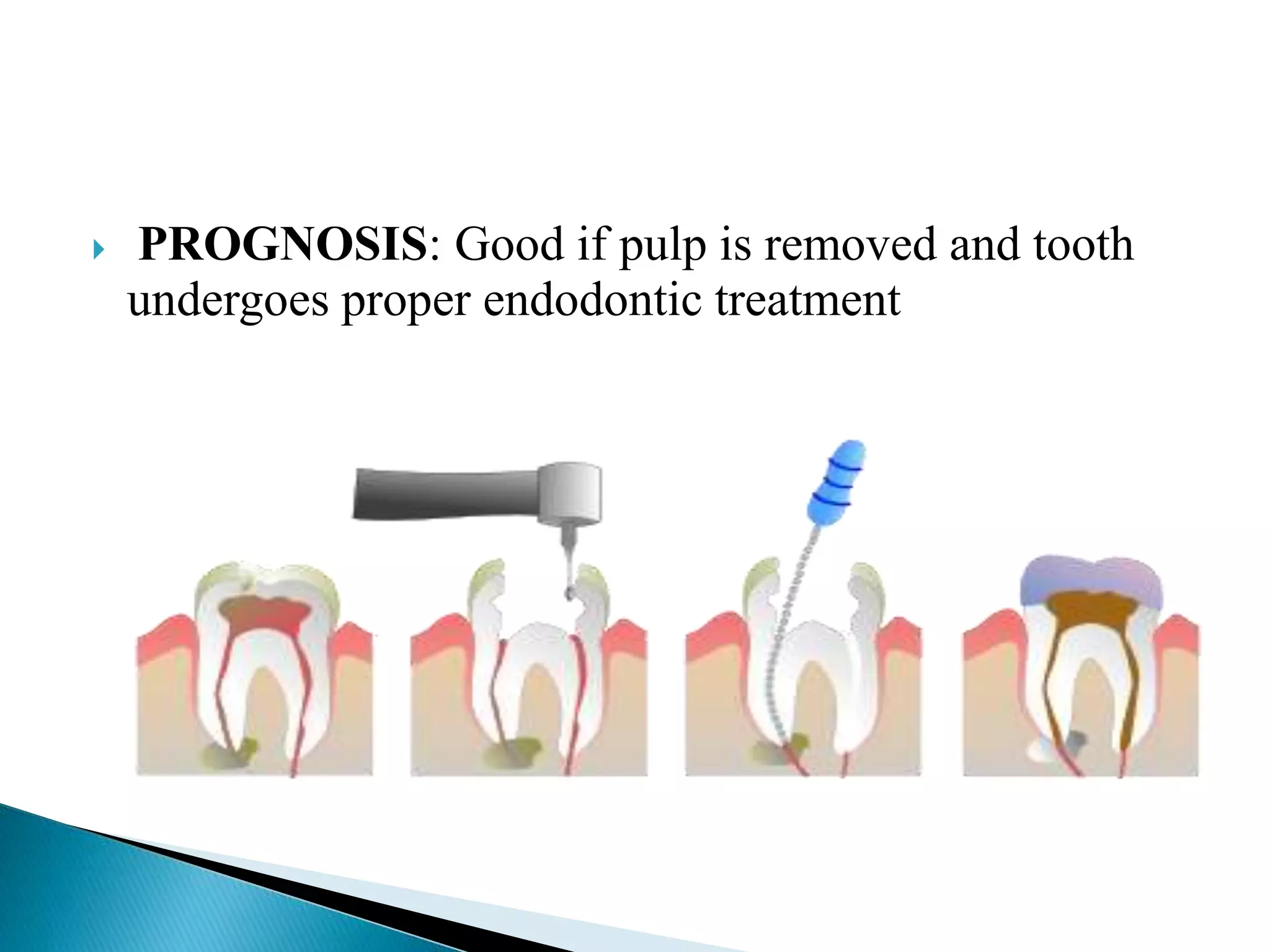 Diseases of pulp | PPTX