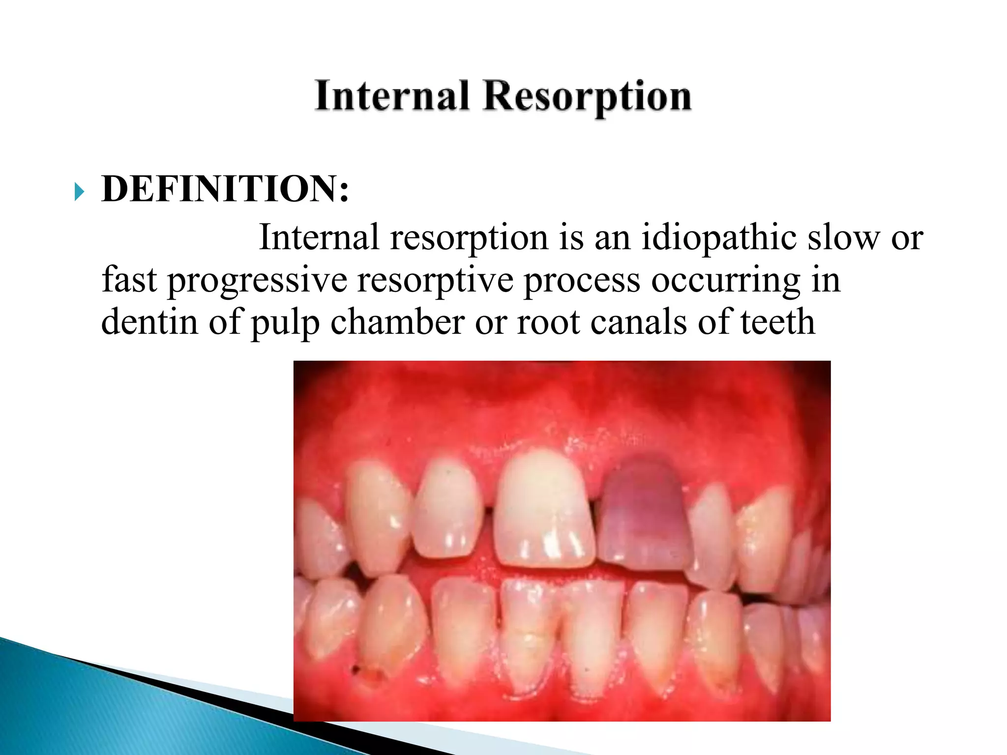 Diseases of pulp | PPTX