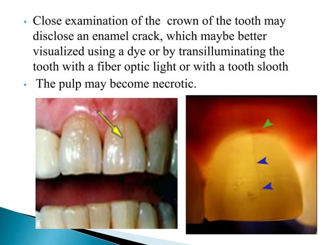 Diseases of pulp | PPTX