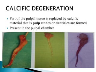 Diseases of pulp | PPTX