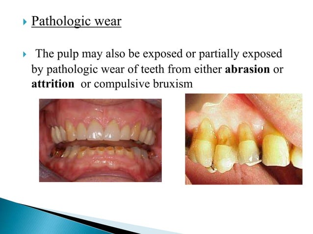 Diseases of pulp | PPTX
