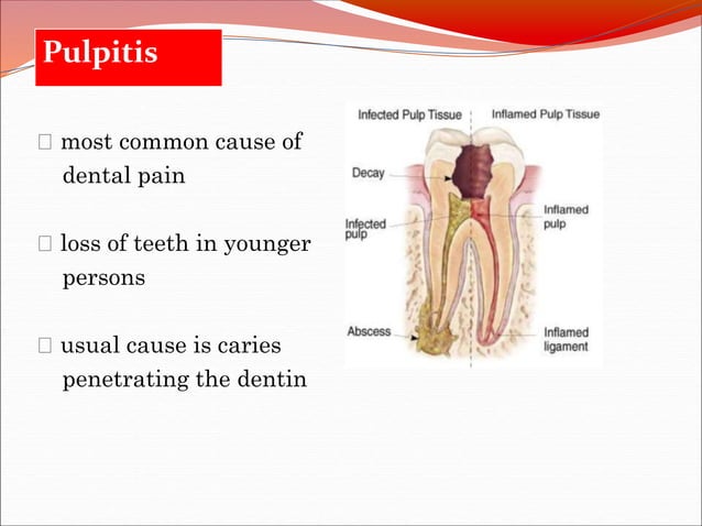 Diseases of pulp | PPTX | Dental Health | Diseases and Conditions