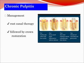 Diseases of pulp | PPTX
