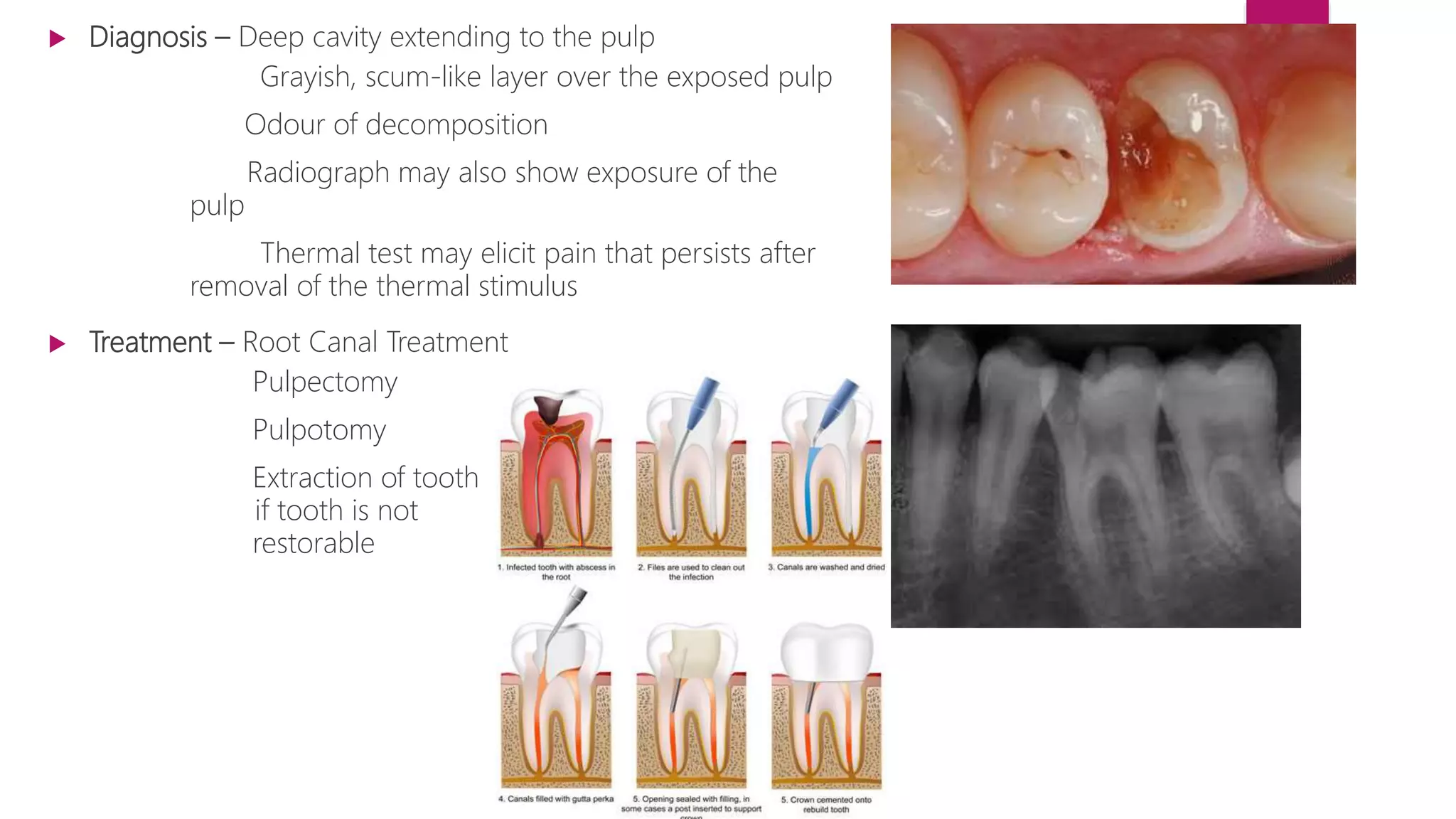 Diseases of pulp | PPTX