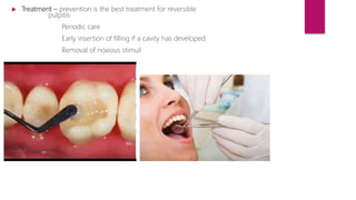 Diseases of pulp | PPTX