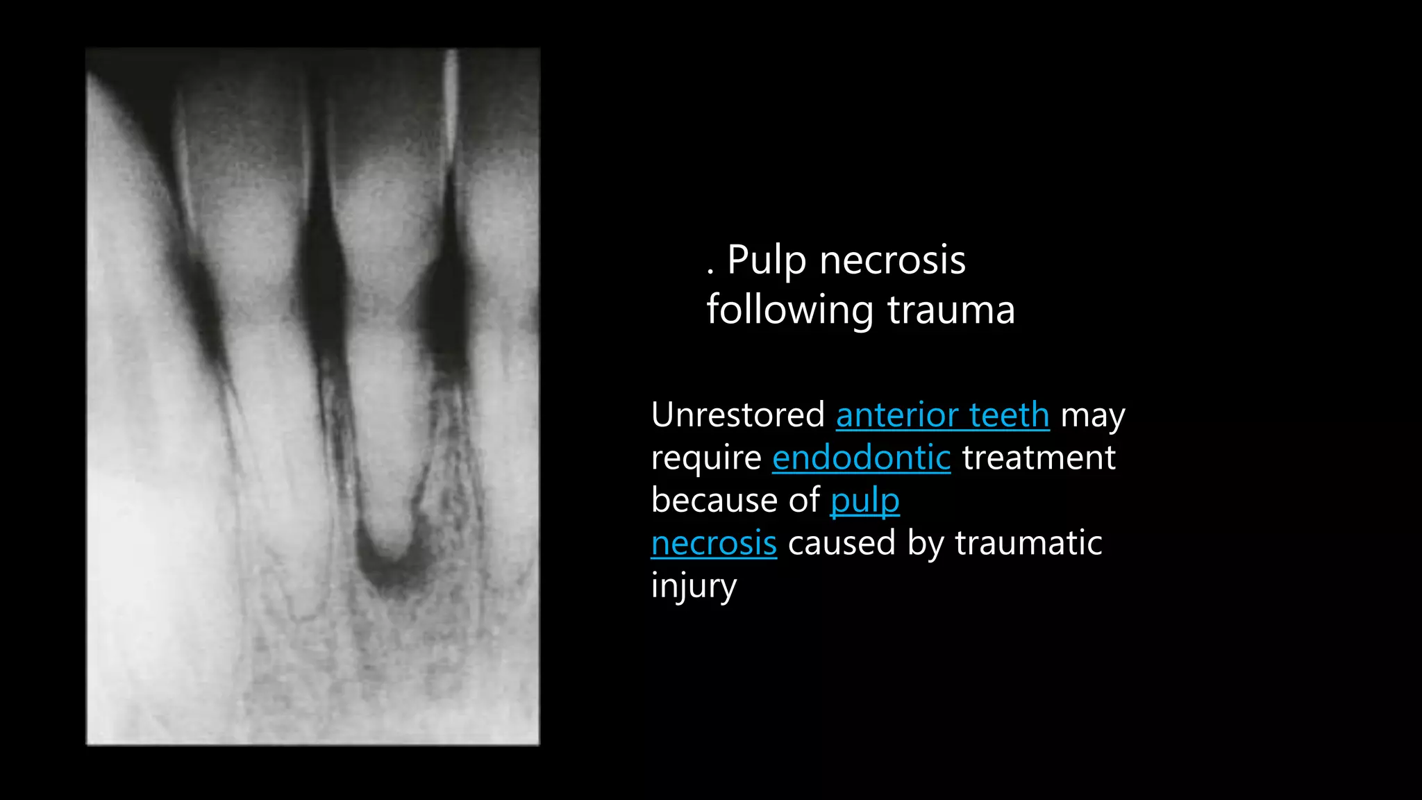 Diseases of pulp | PPTX