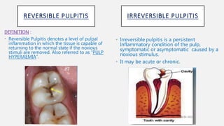 Diseases of pulp | PPTX