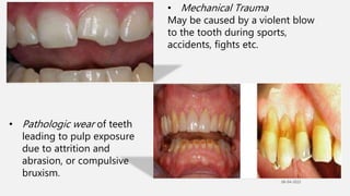 Diseases of pulp | PPTX