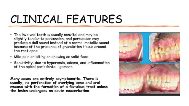 DISEASES OF PULP AND PERIAPICAL TISSUES.pptx