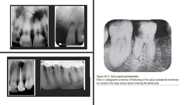 DISEASES OF PULP AND PERIAPICAL TISSUES.pptx