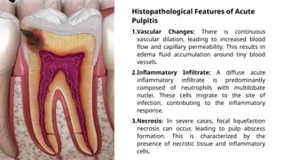 DISEASES OF PULP AND PERIAPICAL TISSUES.pptx
