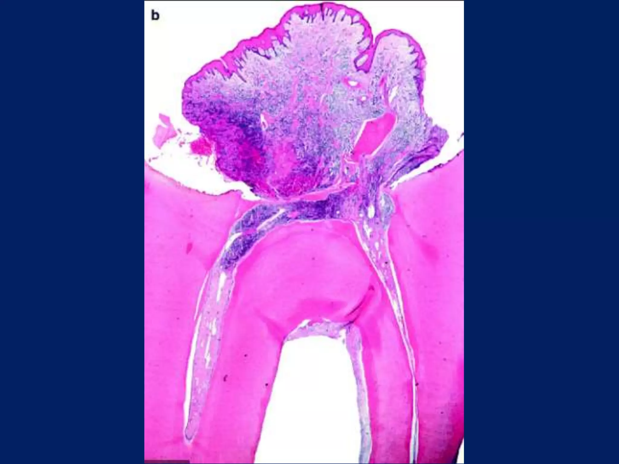 Diseases of pulp and periapical tissues | PPTX | Dental Health ...