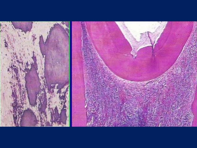 Diseases of pulp and periapical tissues | PPTX | Dental Health ...