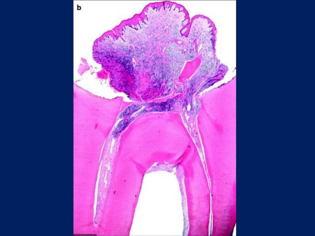 Diseases of pulp and periapical tissues | PPTX | Dental Health ...