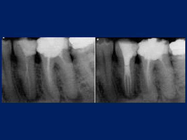 Diseases of pulp and periapical tissues | PPTX | Dental Health ...