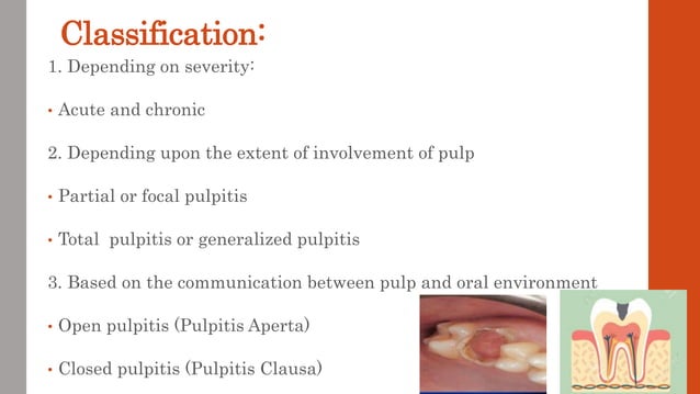 Diseases of pulp for ugs | PPT