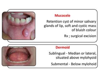 Sublingual Gland Cyst