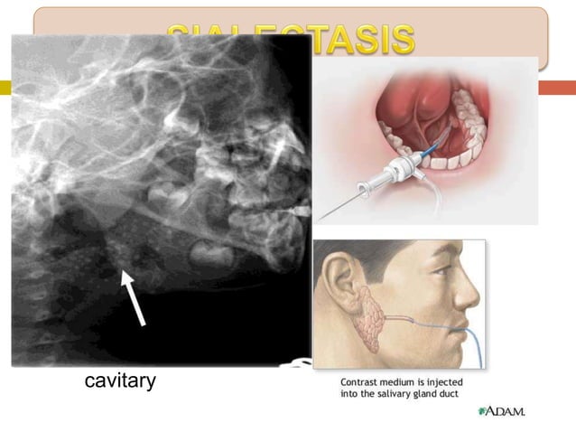 Diseases of salivary gland | PPTX