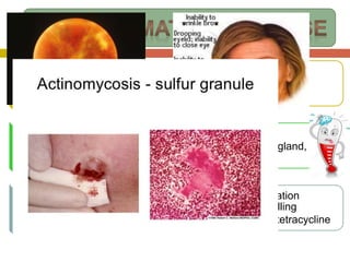 Diseases of salivary gland | PPTX