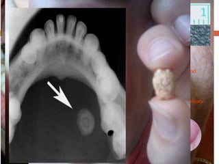 Diseases of salivary gland | PPTX