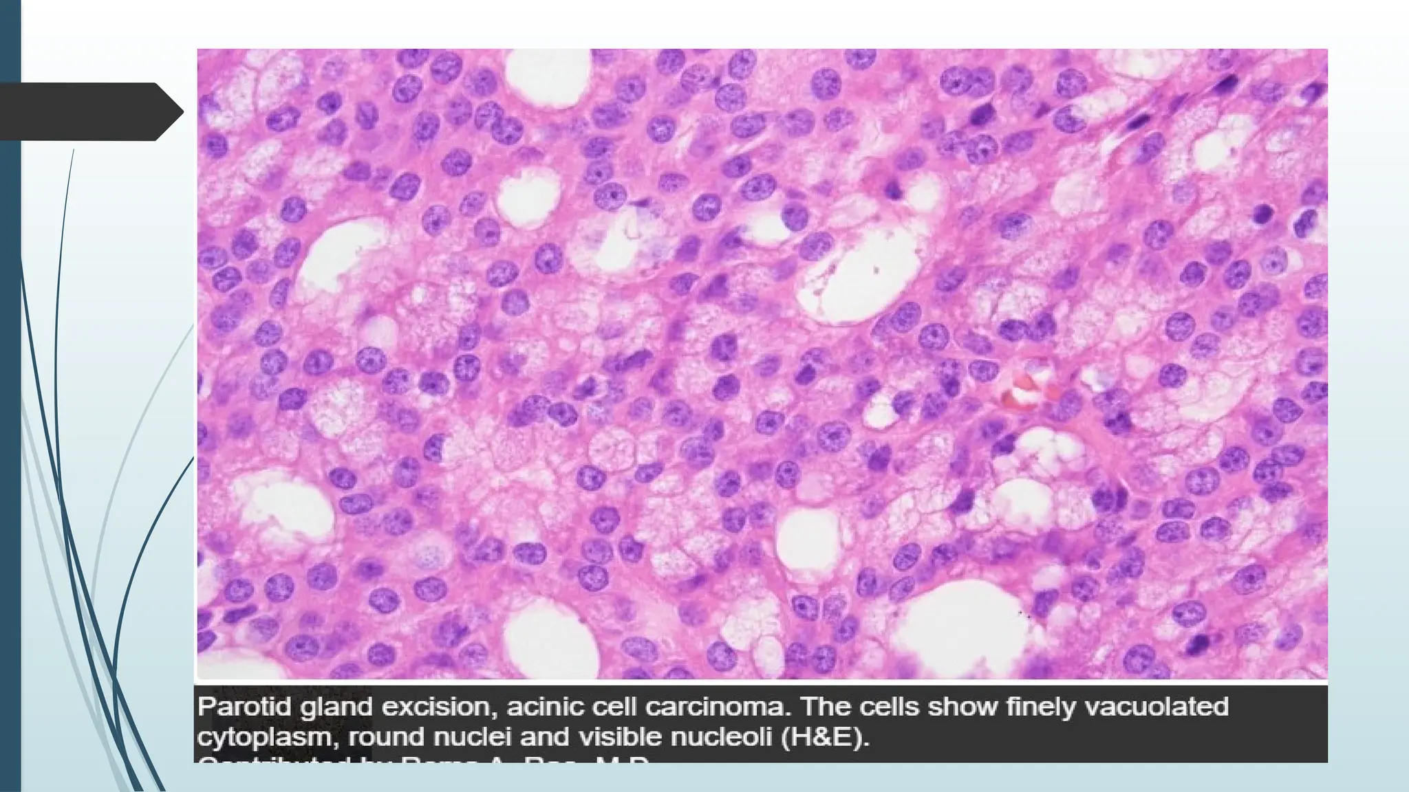 DISEASES OF SALIVARY GLAND II- Pleomorph | PPT
