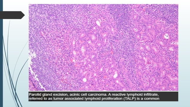 DISEASES OF SALIVARY GLAND II- Pleomorph | PPT