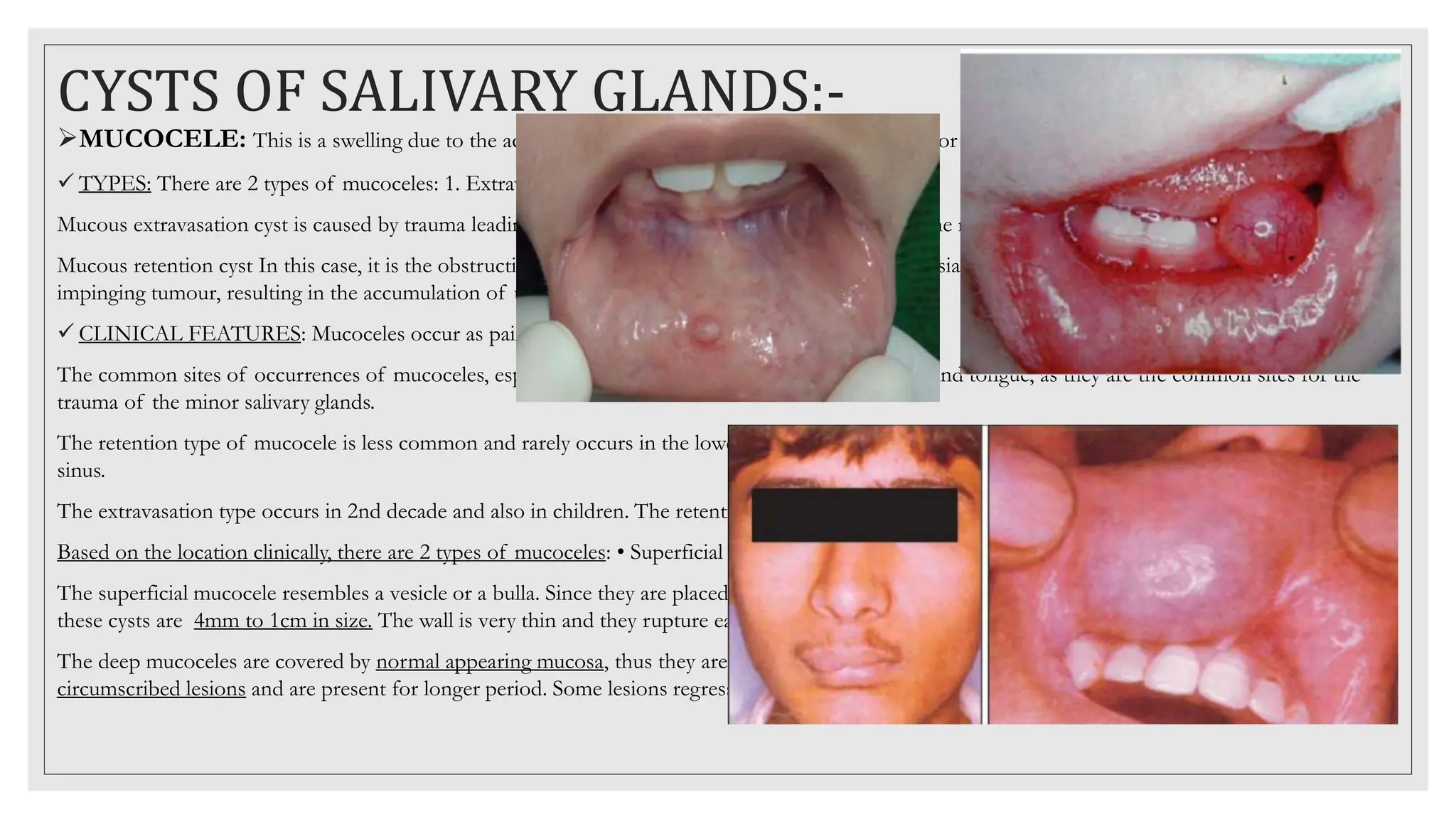 DISEASES OF SALIVARY GLANDS.pptx