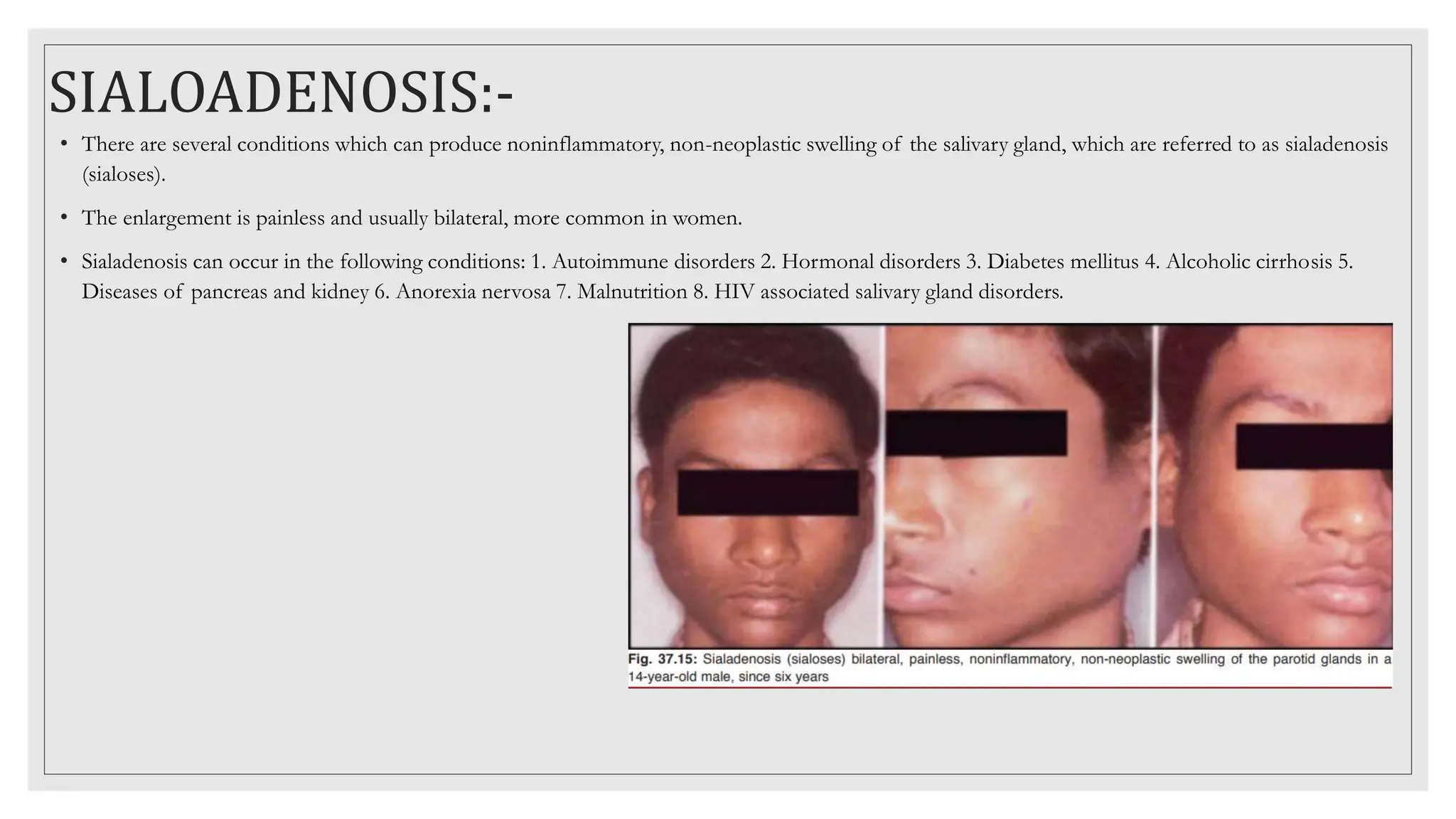 DISEASES OF SALIVARY GLANDS.pptx