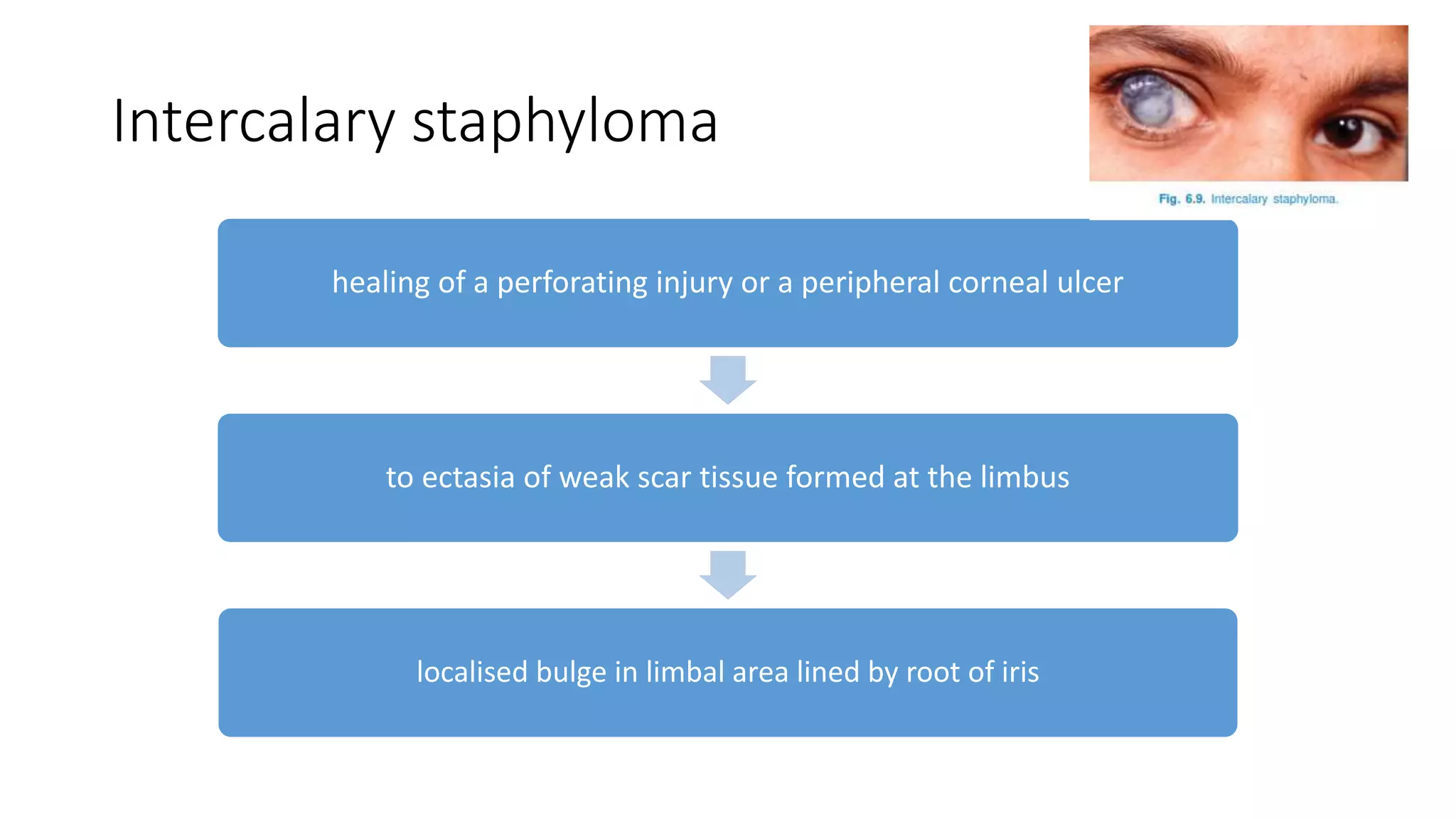 Diseases of sclera | PDF